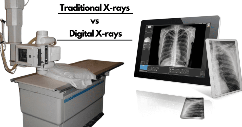 What is the Difference Between Digital x-ray and Normal x-ray?